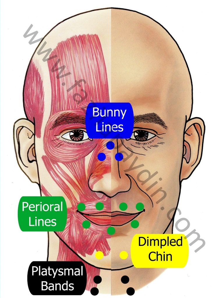 Botox (Botulinum toksin A) | Prof.Dr. Fazıl APAYDIN